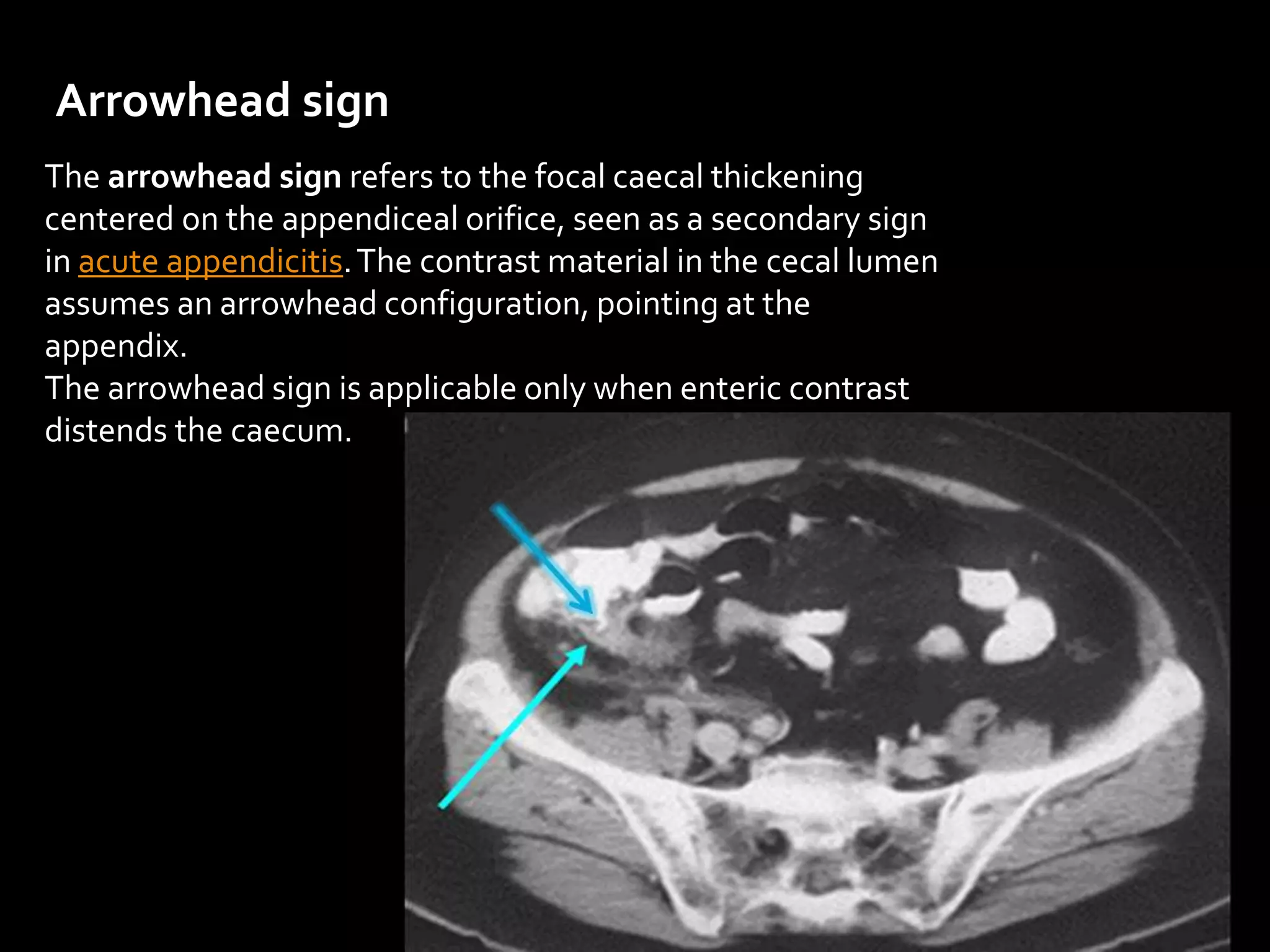 Imaging of Acute Appendicitis | PPTX