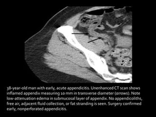 Imaging of Acute Appendicitis | PPTX