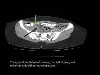 Imaging of Acute Appendicitis | PPTX