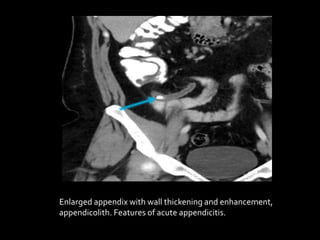 Imaging of Acute Appendicitis | PPTX