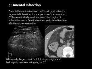 Imaging of Acute Appendicitis | PPTX