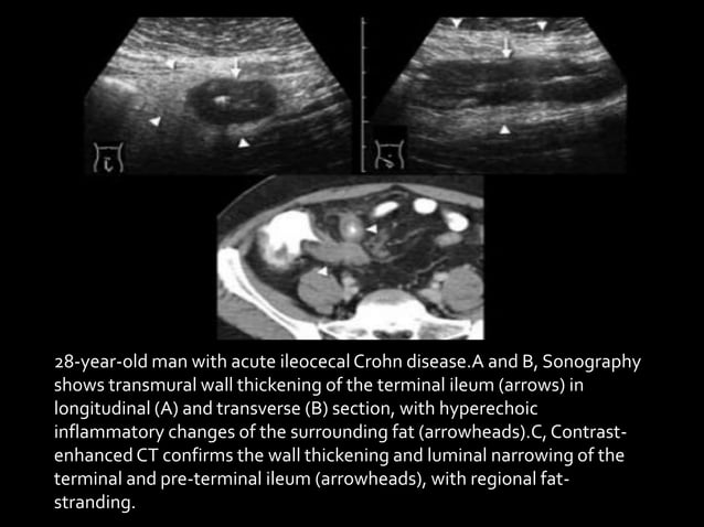 Imaging of Acute Appendicitis | PPTX