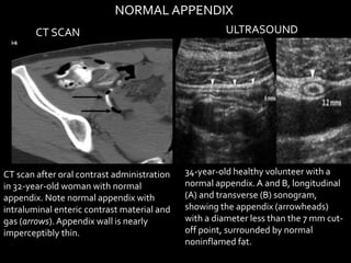 Imaging of Acute Appendicitis | PPTX