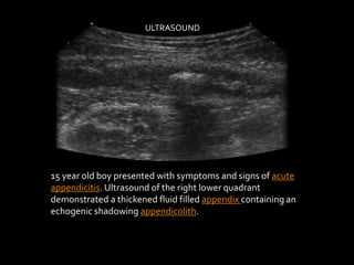 Appendicolith Ultrasound