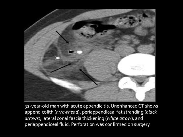 Imaging of Acute Appendicitis