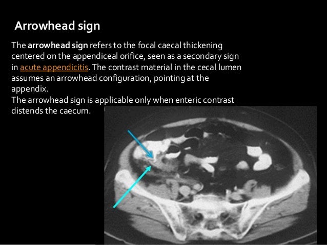Imaging of Acute Appendicitis