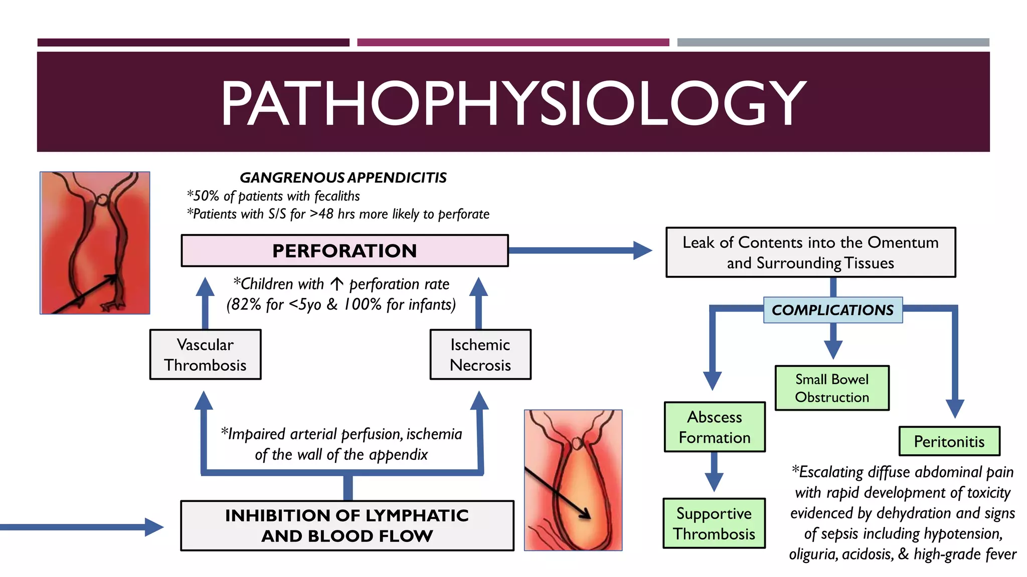 Acute Appendicitis | PDF