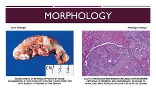 Acute Appendicitis | PDF