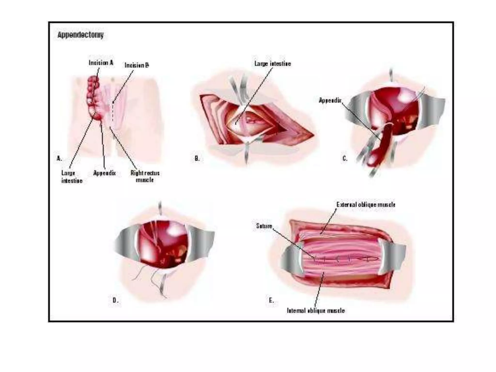 Acute appendicitis | PPTX