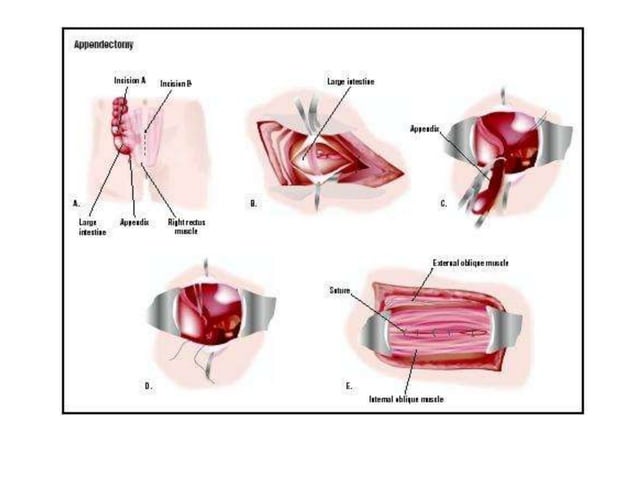 Acute appendicitis | PPTX