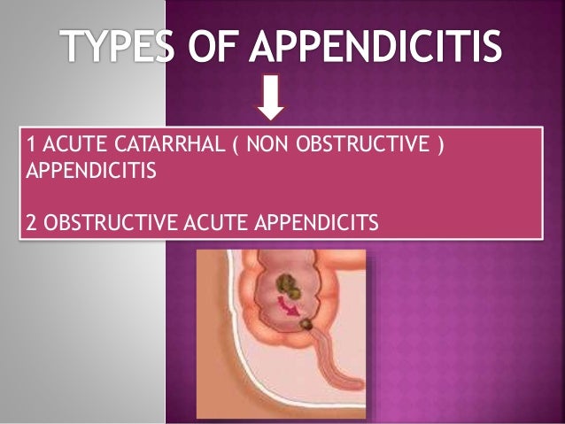 Acute appendicitis