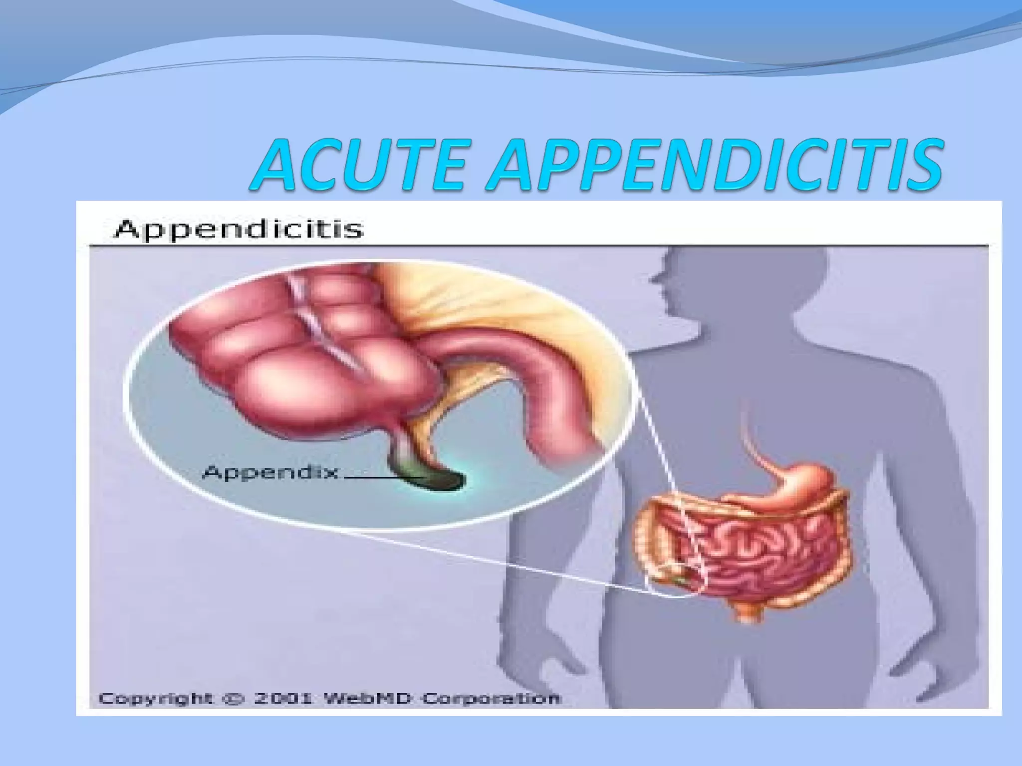 Acute appendicitis __ | PPT