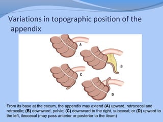 Acute appendicitis __ | PPT