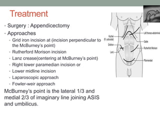 Acute appendicitis | PPTX
