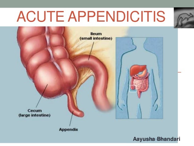 Acute appendicitis