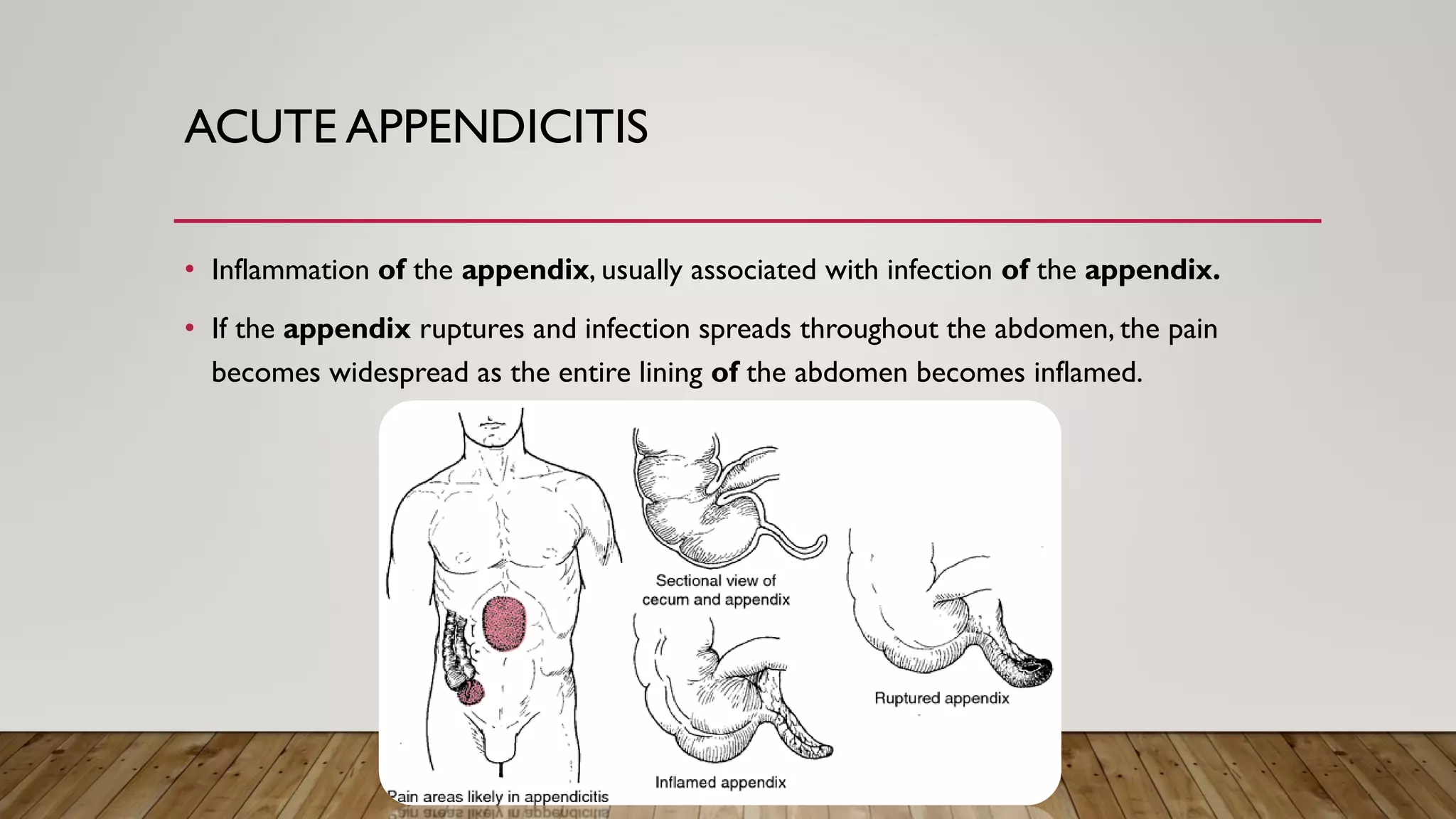 Acute appendicitis | PDF | Digestive Disorders | Diseases and Conditions