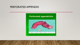 Acute appendicitis | PDF