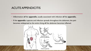 Acute appendicitis | PDF