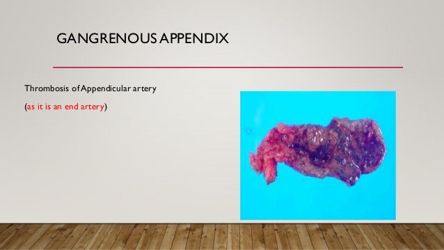 Acute appendicitis