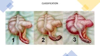 Acute appendicitis | PPT | Free Download