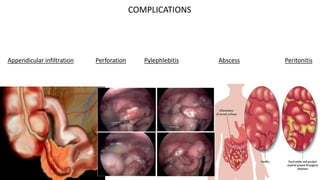 Acute appendicitis | PPT | Free Download