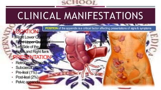 Acuteappendicitis | PPT