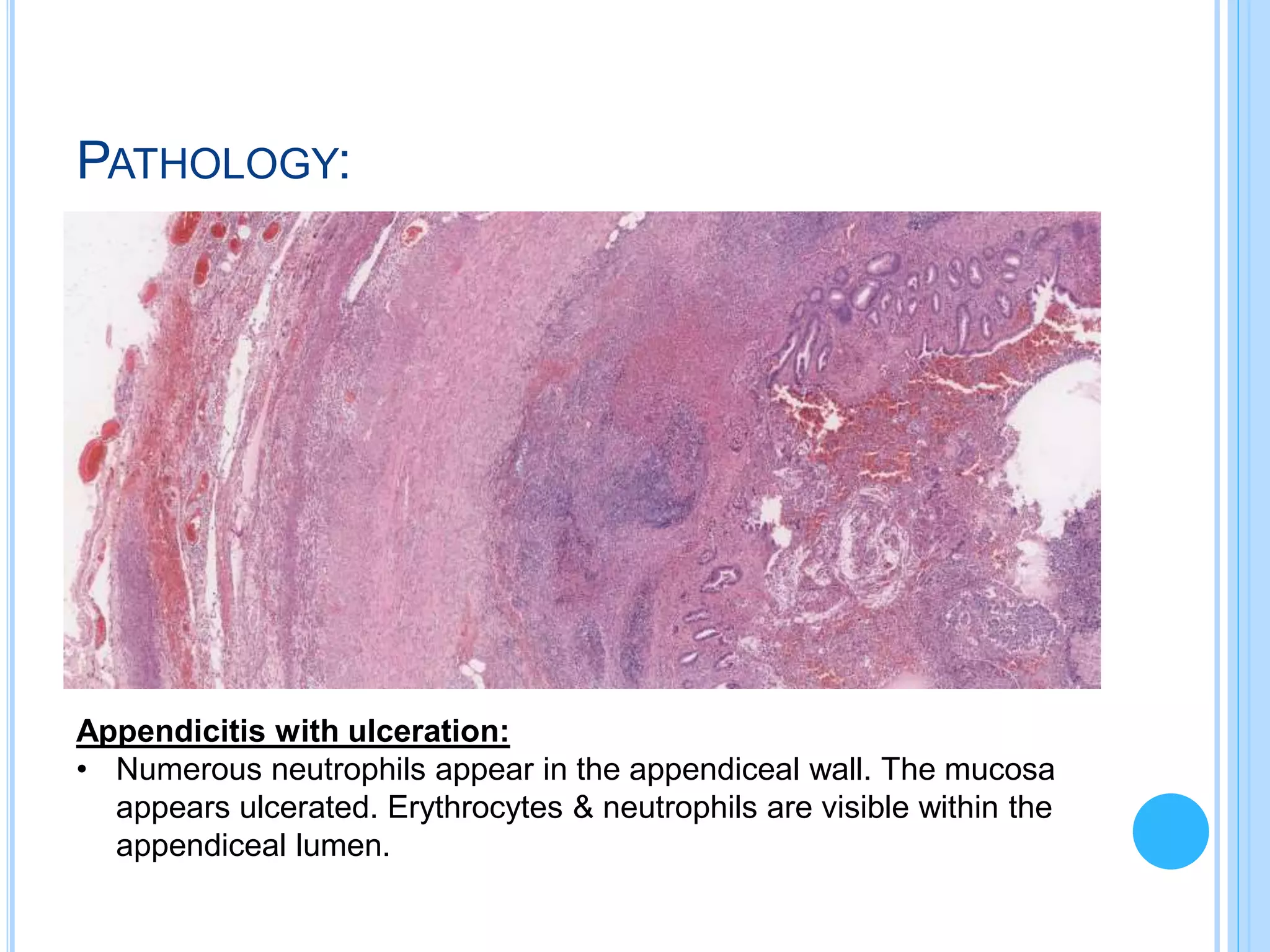 Acute appendicitis | PPTX
