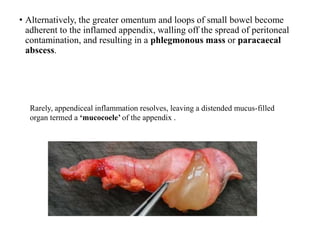 Acute Appendicitis-١.pptx
