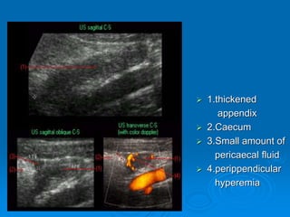 Acute Appendicitis.ppt