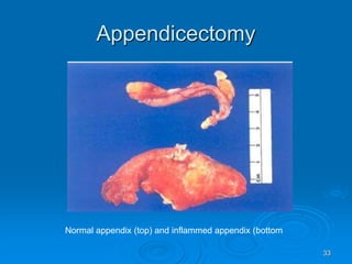 Acute Appendicitis.ppt