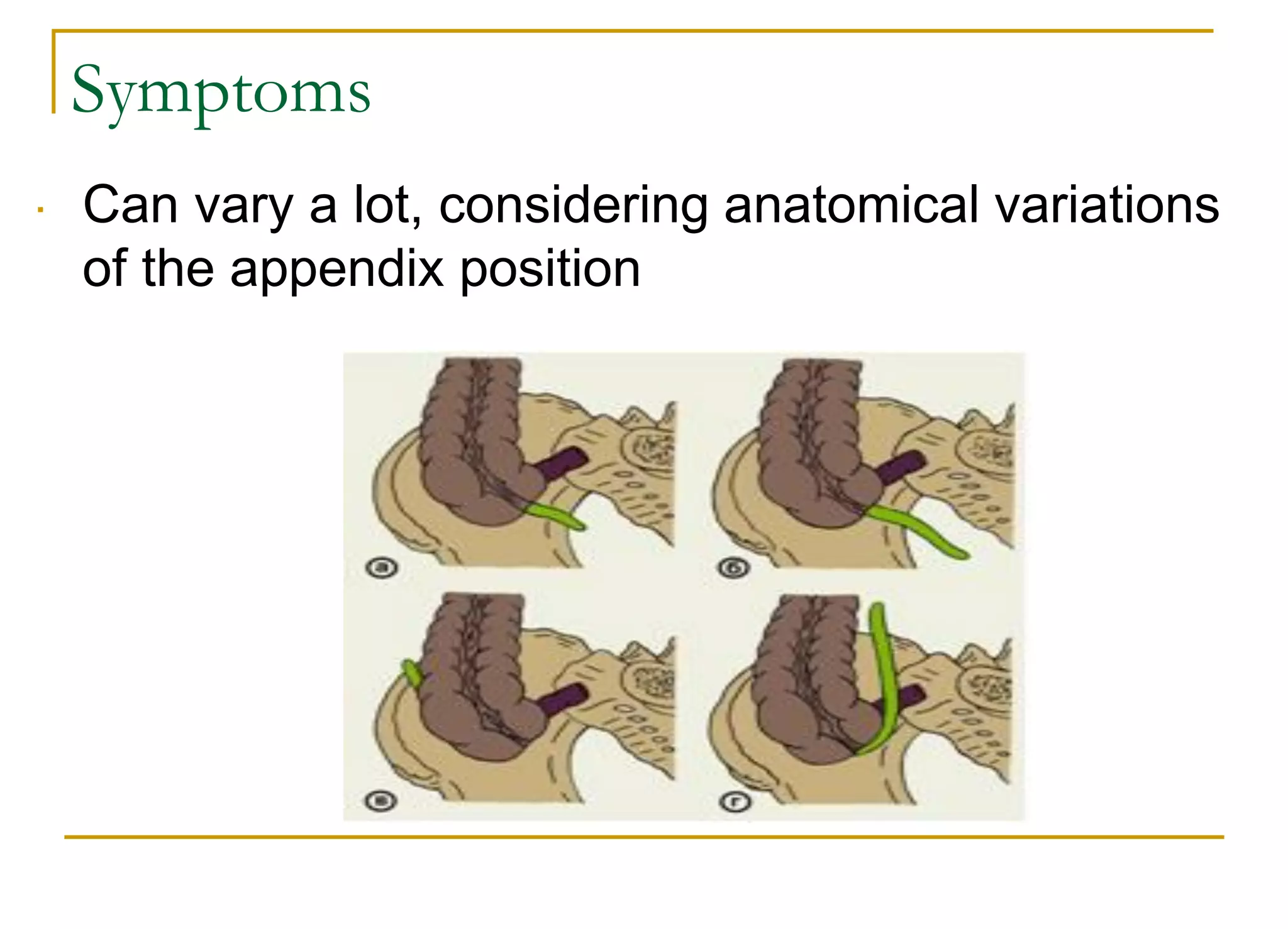 Acute appendicitis.pdf