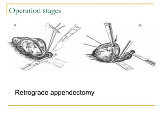Acute appendicitis.pdf