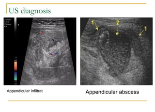 Acute appendicitis.pdf