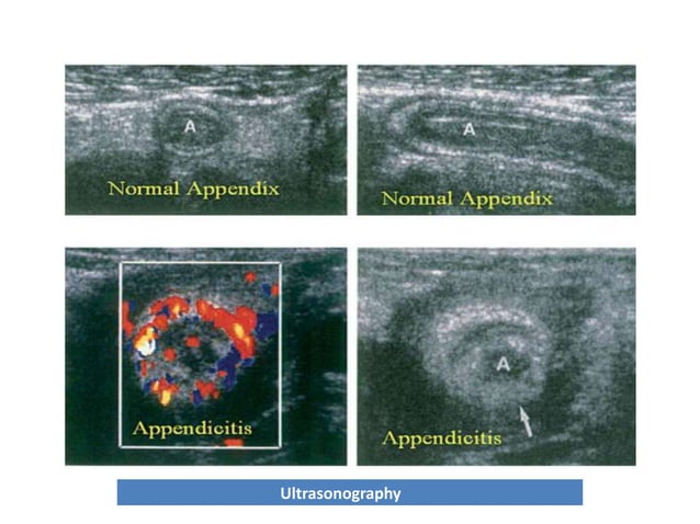 Acute appendicitis.ppt