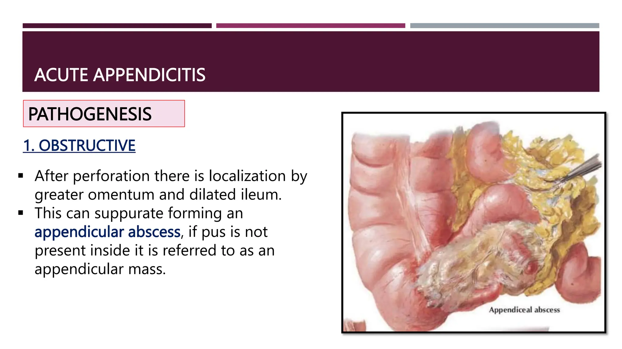 ACUTE APPENDICITIS: anatomy, aetiology, types, clinical features.pptx ...