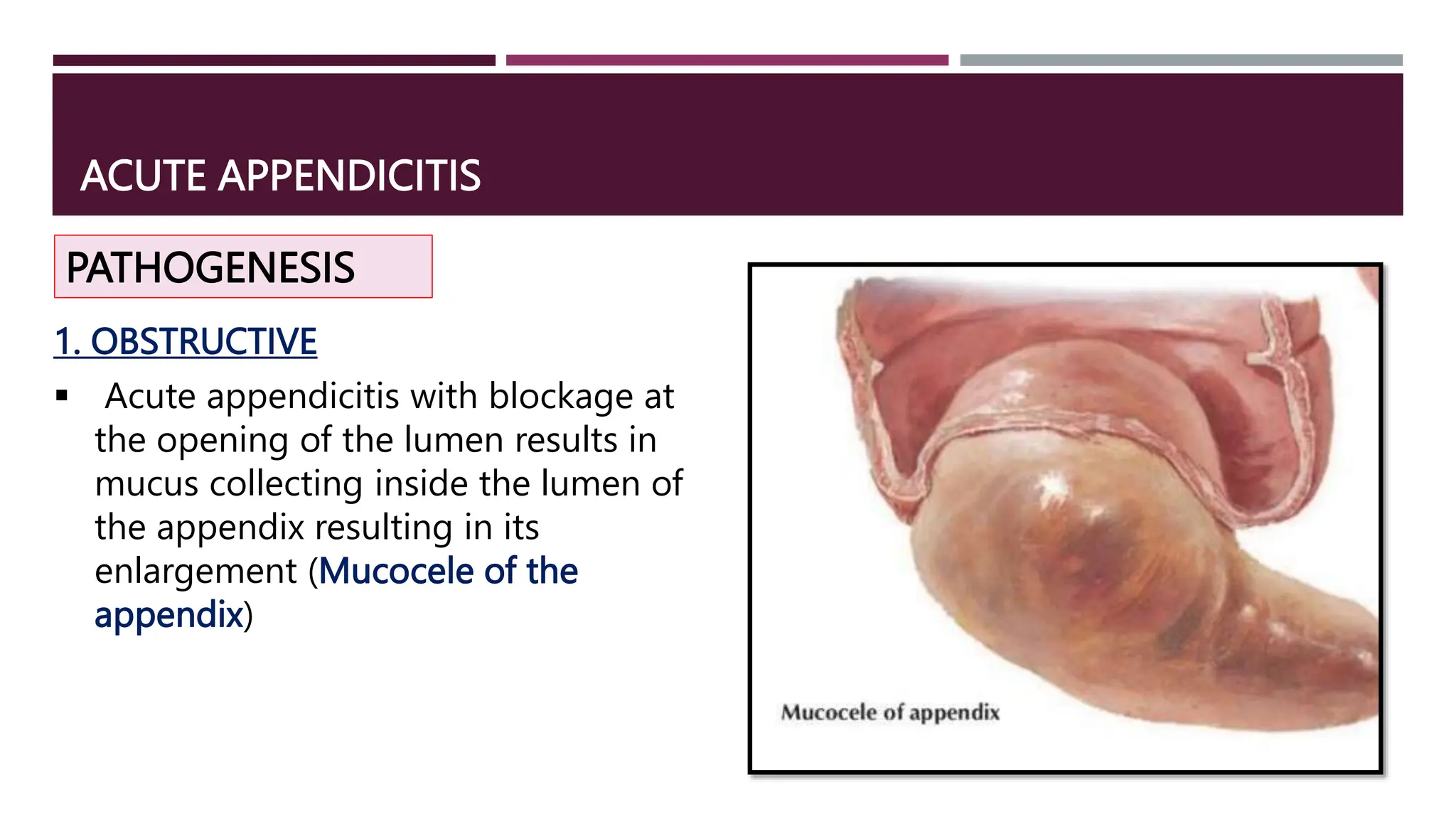 ACUTE APPENDICITIS: anatomy, aetiology, types, clinical features.pptx