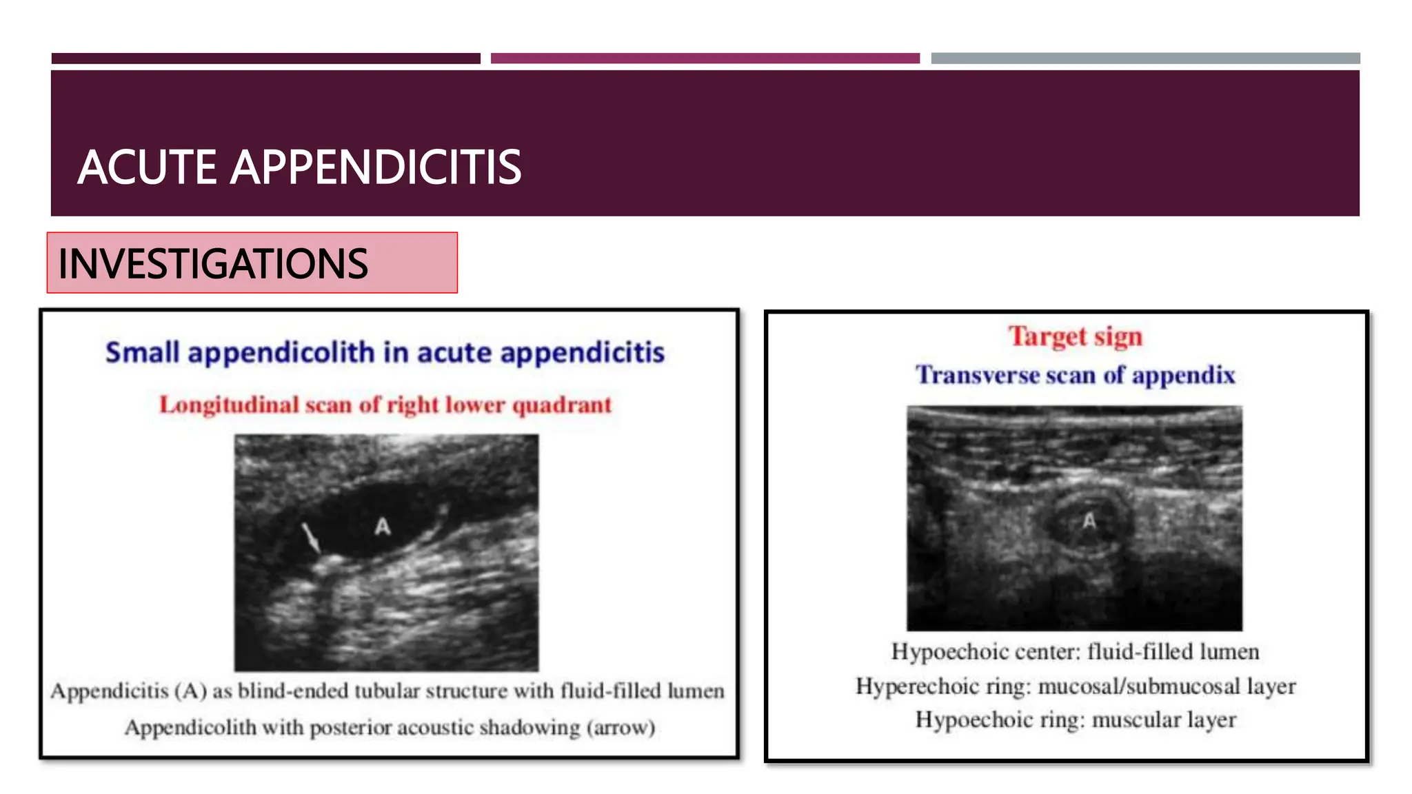 ACUTE APPENDICITIS: anatomy, aetiology, types, clinical features.pptx ...