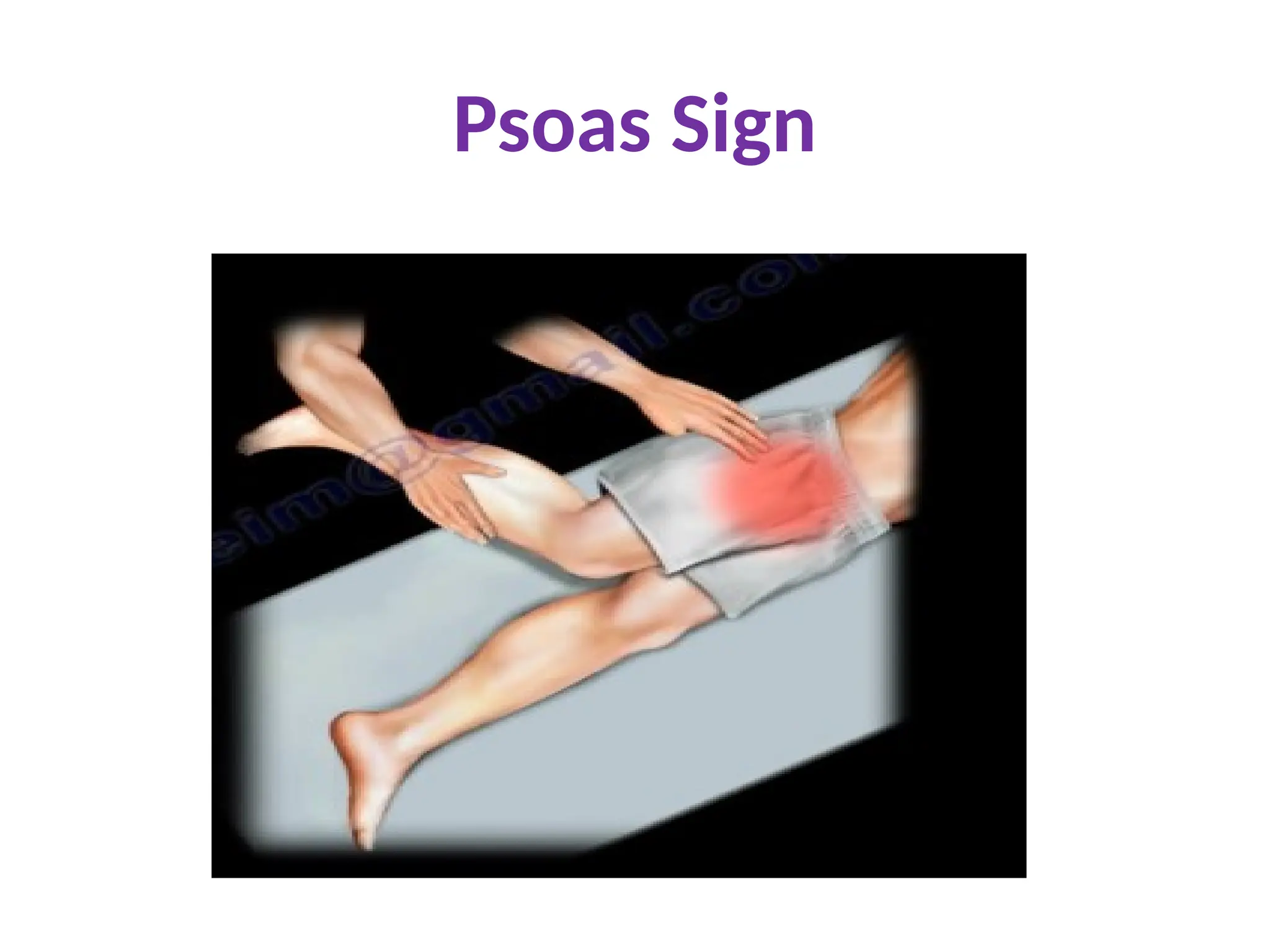 Acute Appendicitis and Homoeopathy...... | PPTX