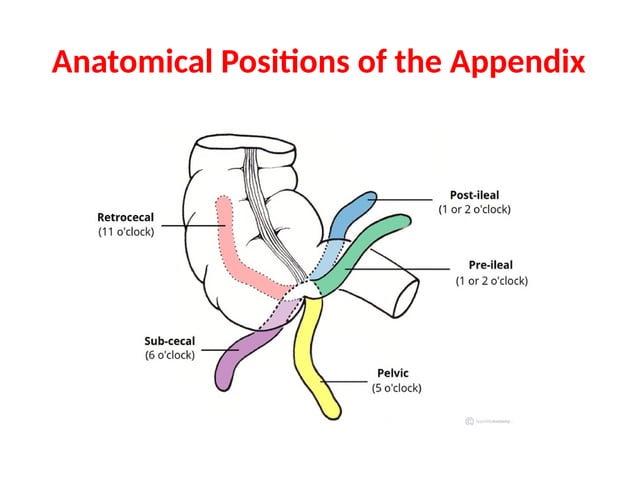 Acute Appendicitis and Homoeopathy...... | PPT