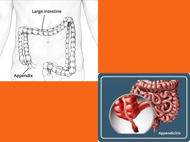 Acute Appendicitis etiology, diagnosis, management | PPT