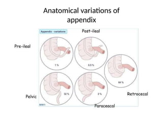 Acute Appendicitis in detail and it's management.pptx