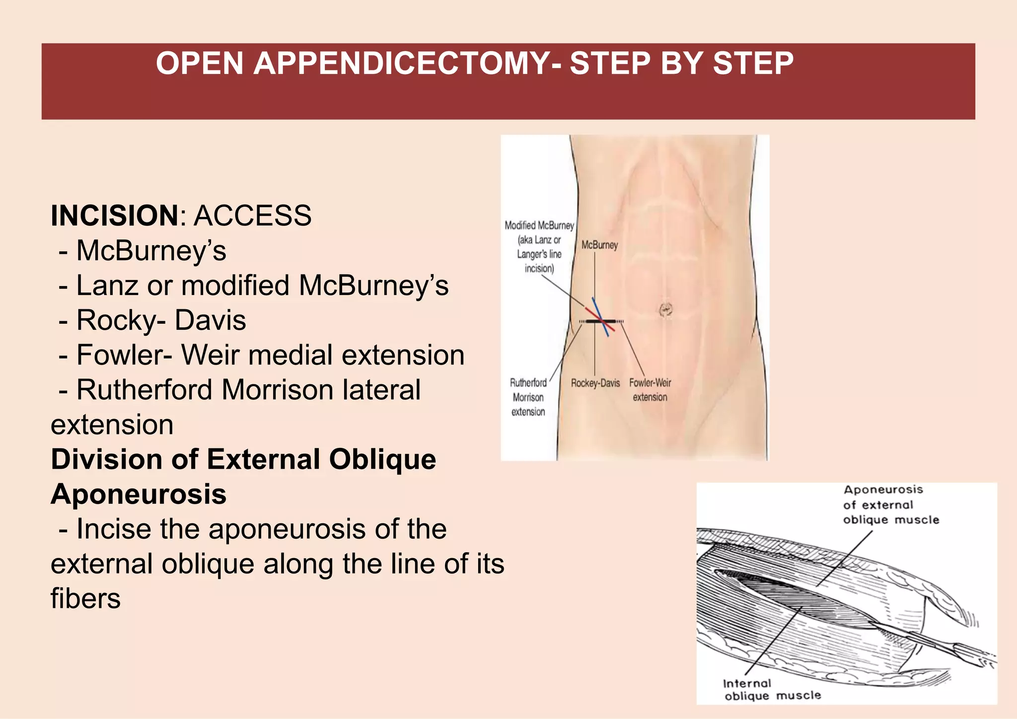 Acute Appendicitis- Appendicectomy- Open & Laparoscopic.pdf
