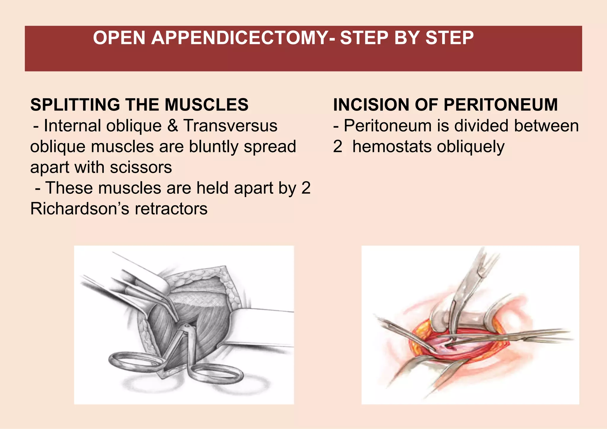 Acute Appendicitis- Appendicectomy- Open & Laparoscopic.pdf