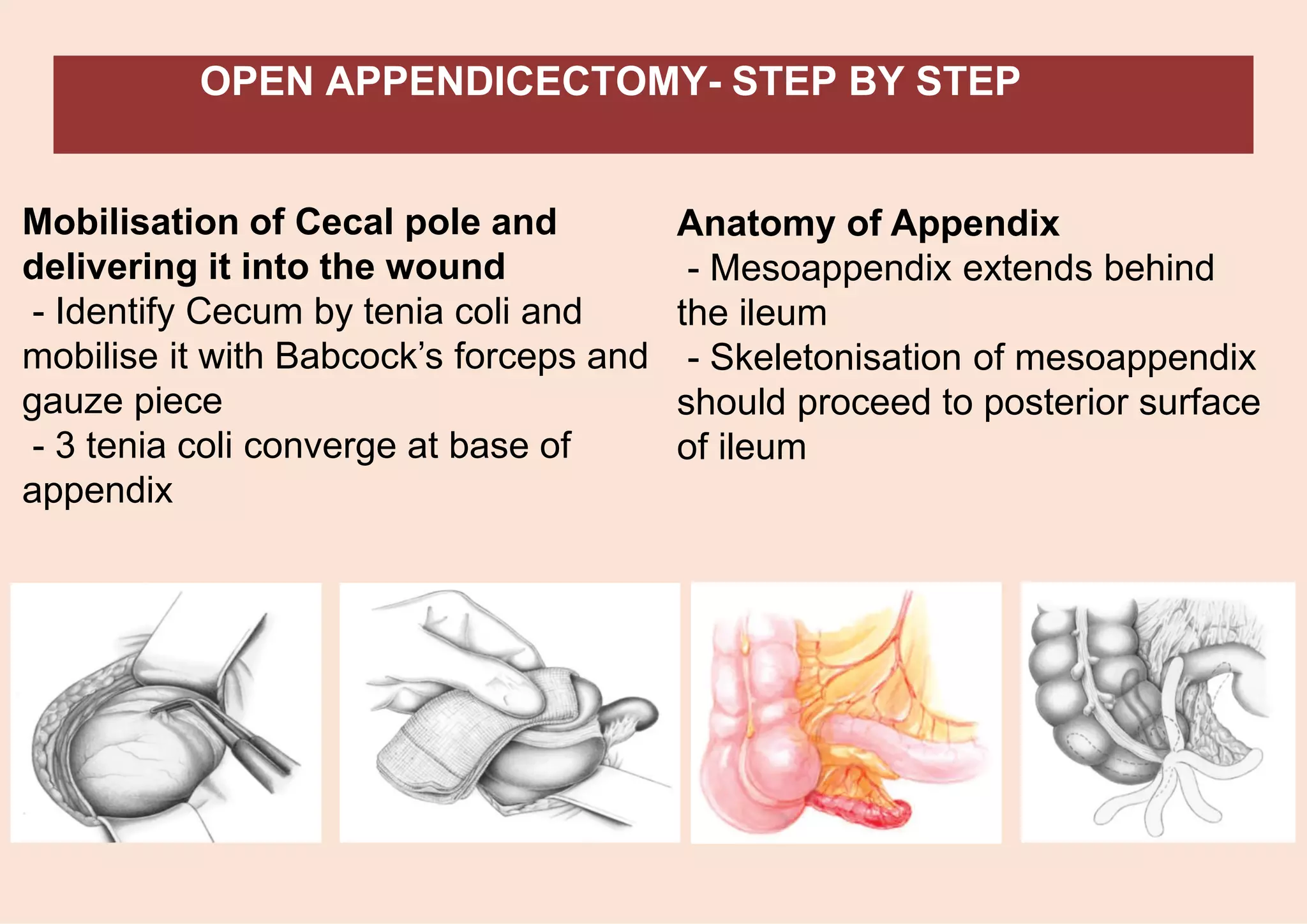 Acute Appendicitis Appendicectomy Open And Laparoscopic Pdf