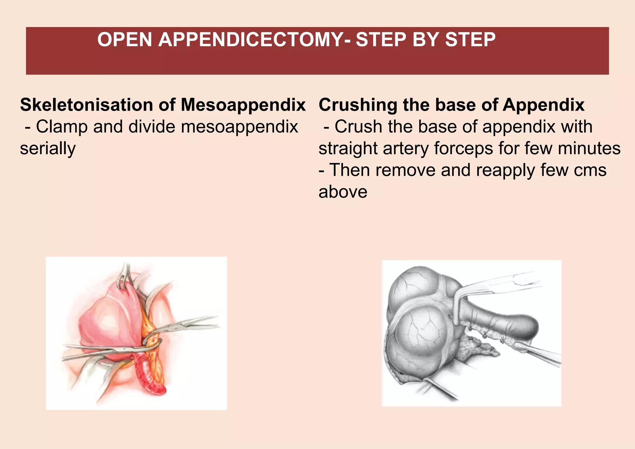 Acute Appendicitis- Appendicectomy- Open & Laparoscopic.pdf