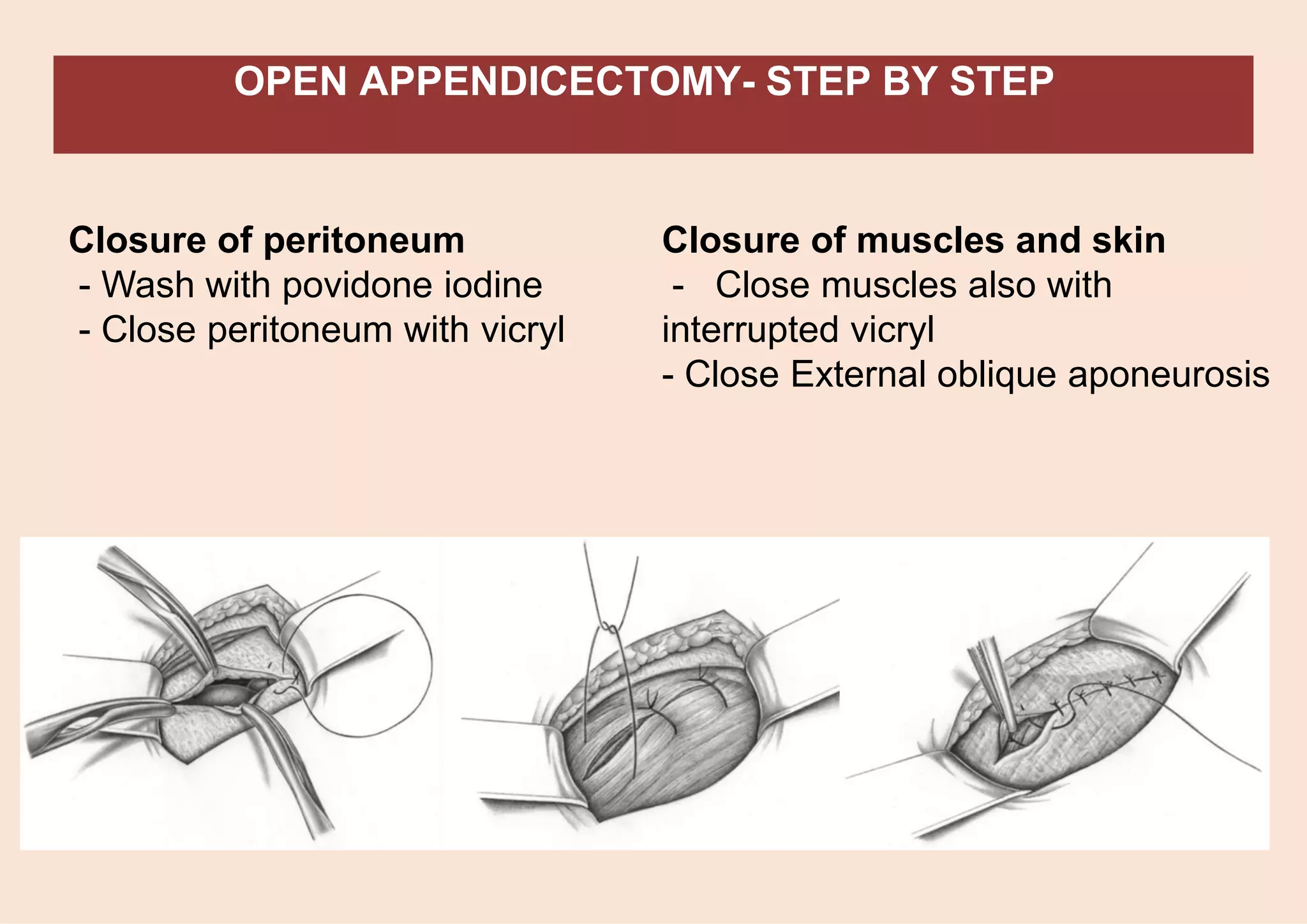 Acute Appendicitis- Appendicectomy- Open & Laparoscopic.pdf