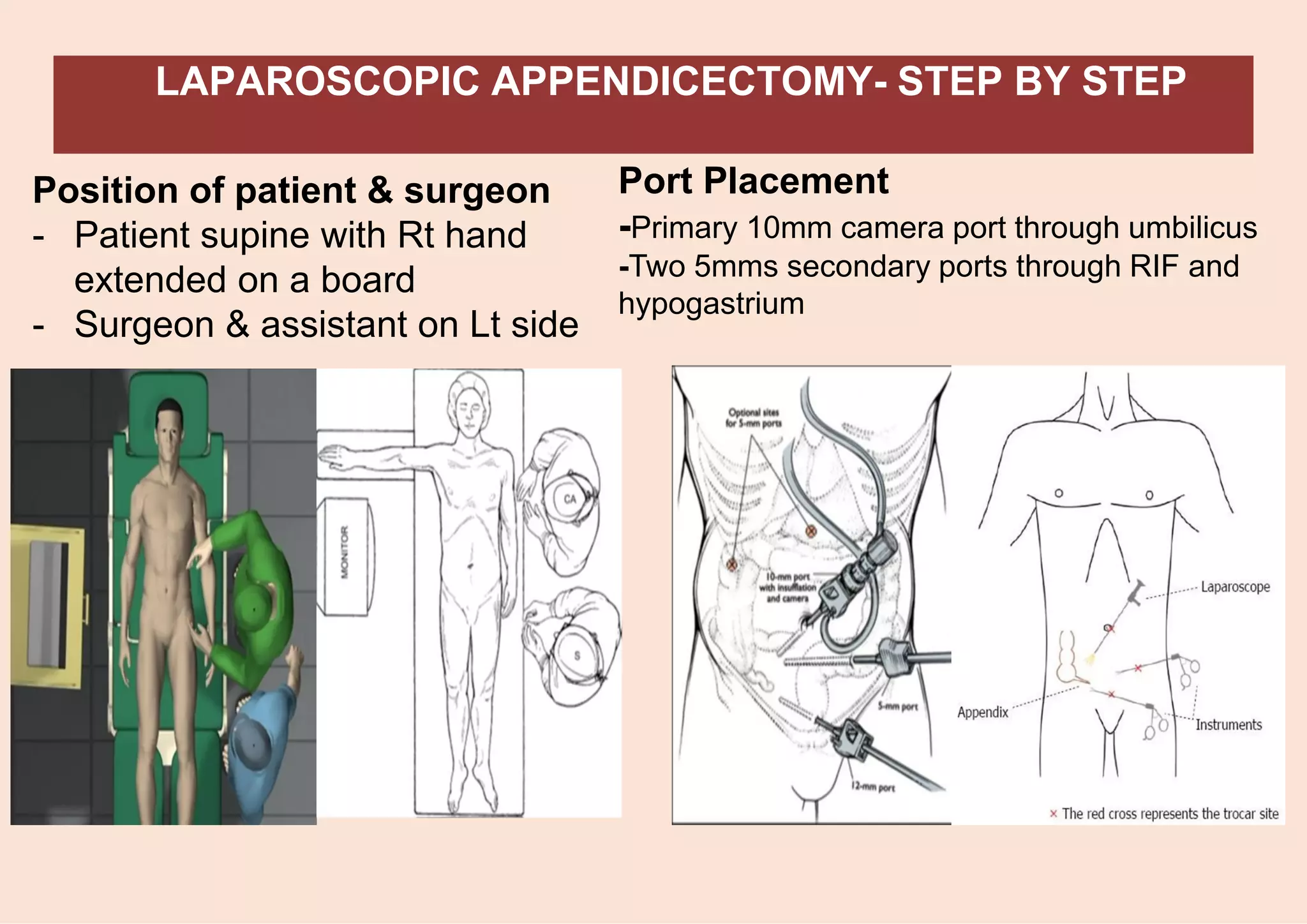 Acute Appendicitis- Appendicectomy- Open & Laparoscopic.pdf