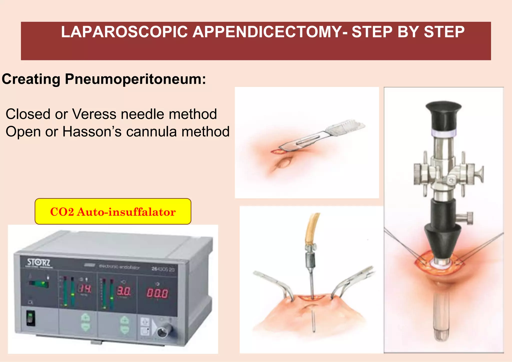Acute Appendicitis- Appendicectomy- Open & Laparoscopic.pdf