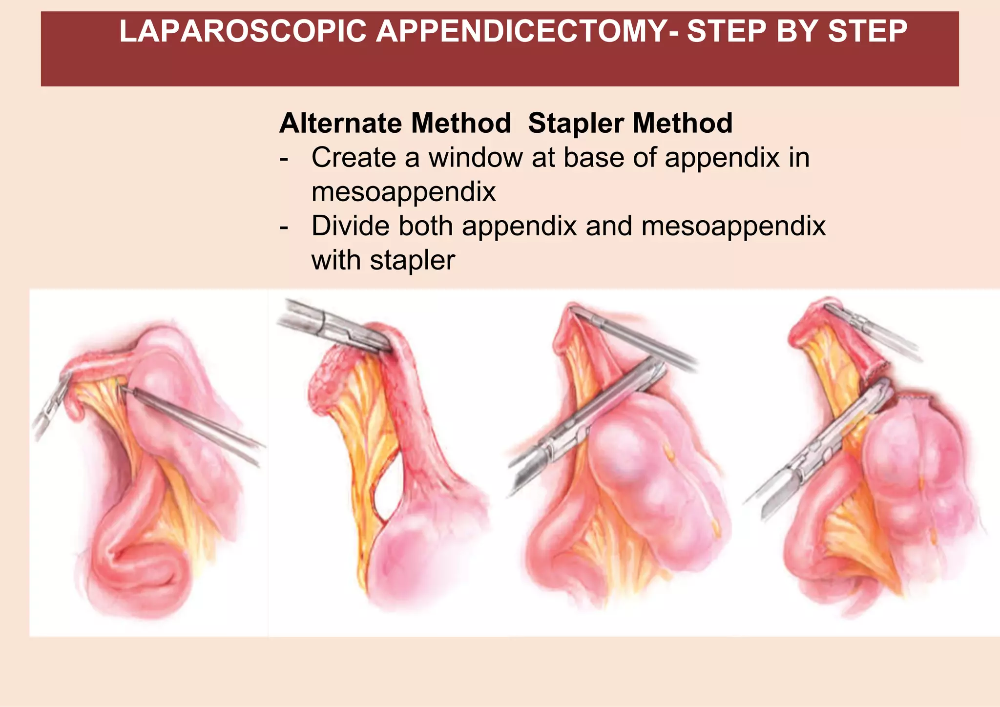 Acute Appendicitis- Appendicectomy- Open & Laparoscopic.pdf