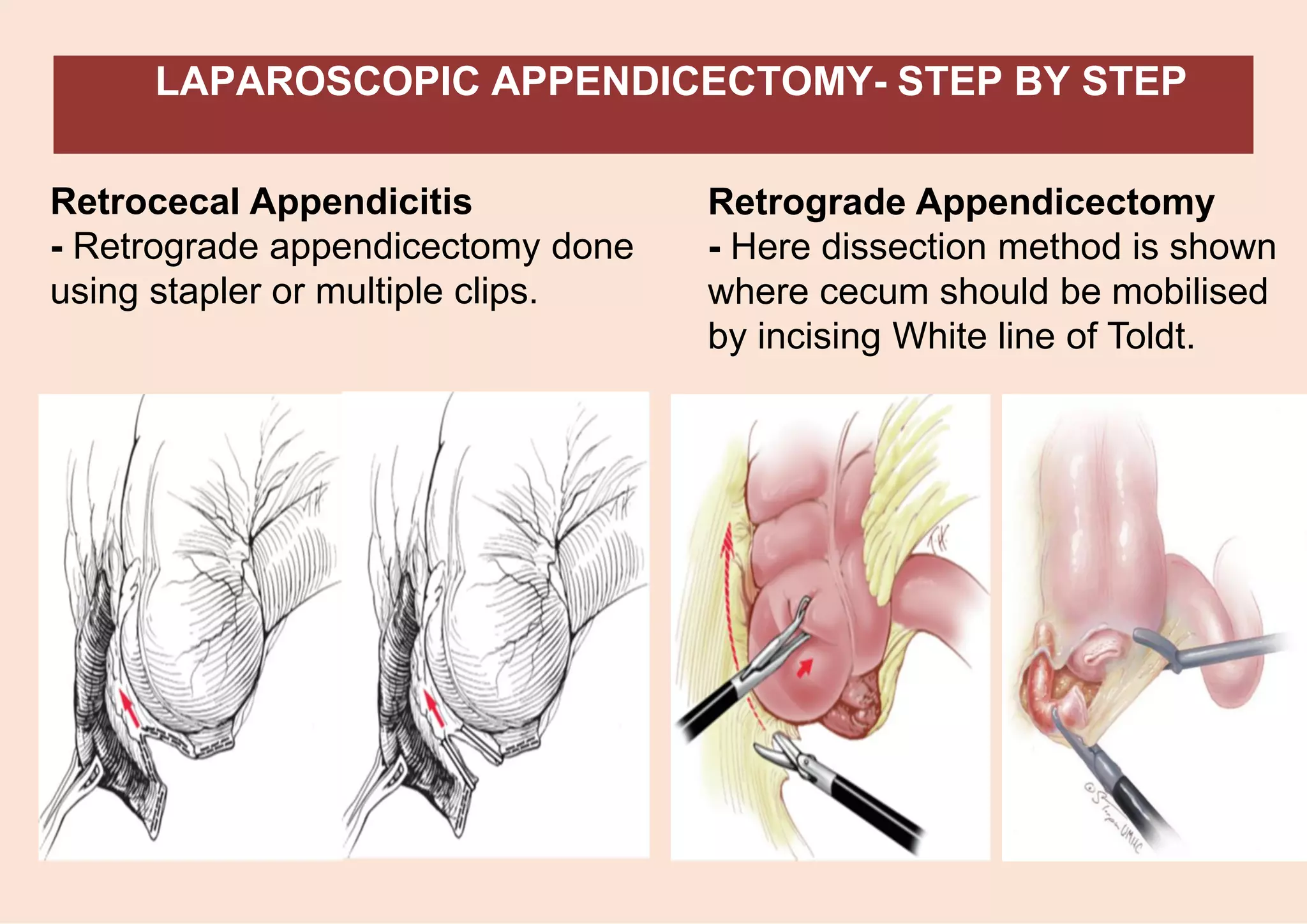 Acute Appendicitis- Appendicectomy- Open & Laparoscopic.pdf